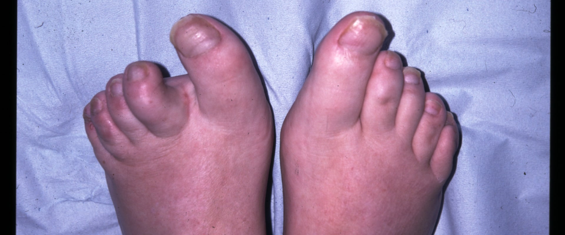 Understanding Psoriatic Arthritis and Foot Pain: An Expert's Perspective