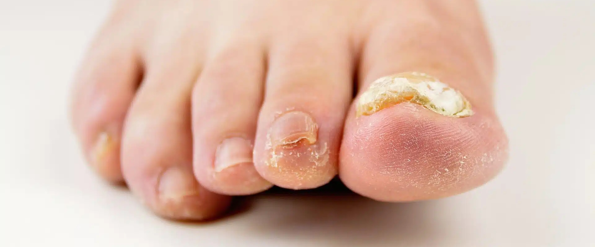What Do Diabetic Toenails Look Like? A Step-by-Step Guide to ...
