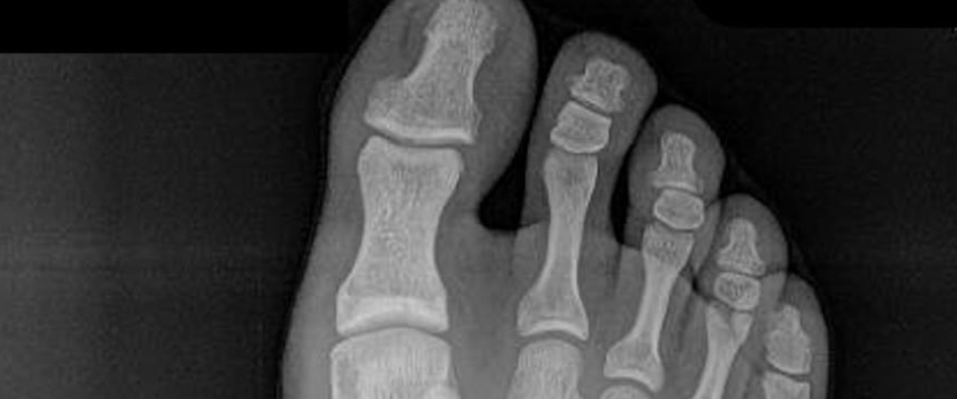 Understanding Lisfranc Injuries: Signs, Symptoms, and Treatment